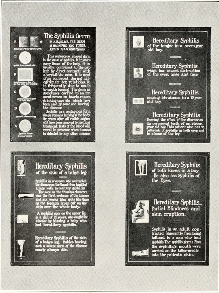 The Rise of Congenital Syphilis | Baby News (and History) – The Baby ...
