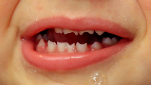 The Rise of Congenital Syphilis | Baby News (and History) – The Baby ...